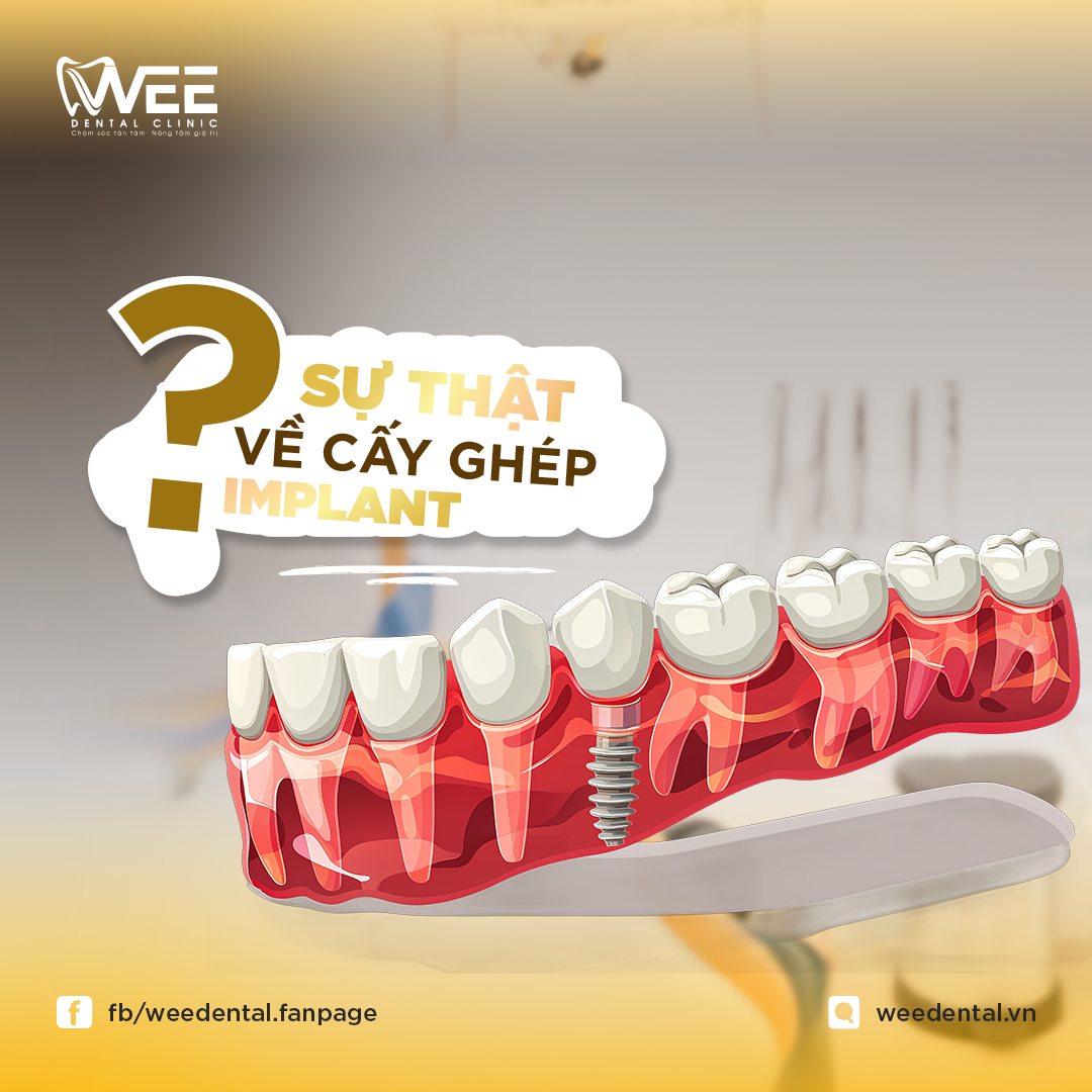 CẤY GHÉP IMPLANT LÀ GÌ? SỰ THẬT VỀ CẤY GHÉP IMPLANT? - Wee Dental 2026